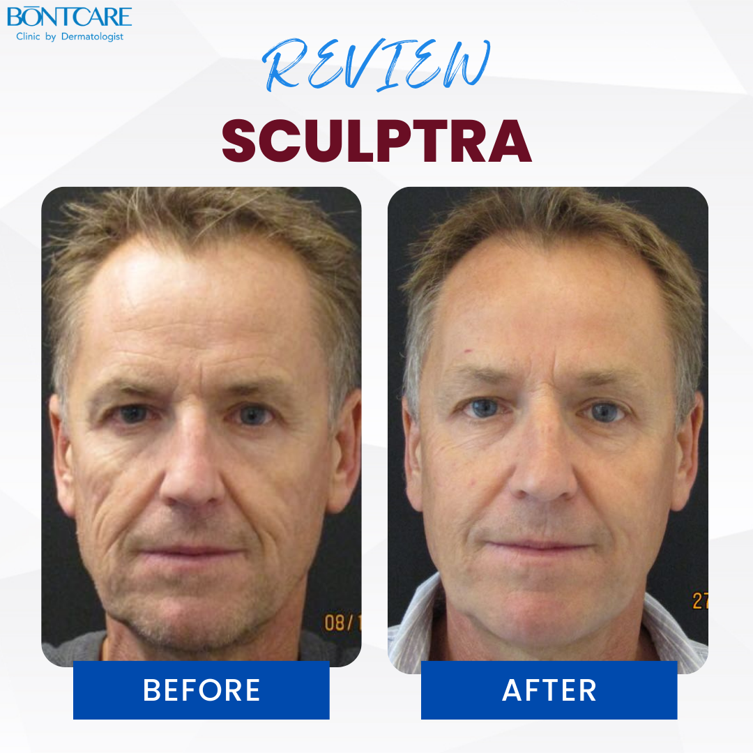 SCULPTRA - บอนท์แคร์คลินิก โดยแพทย์เฉพาะทางผิวหนัง
